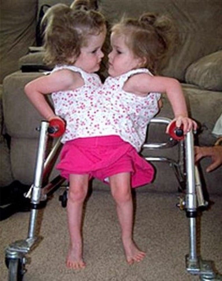 El testimonio de las siamesas que fueron separadas y cada una se quedó ...