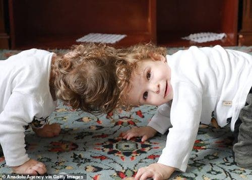 El desenlace de los gemelos siameses que lucharon por ser separados ...