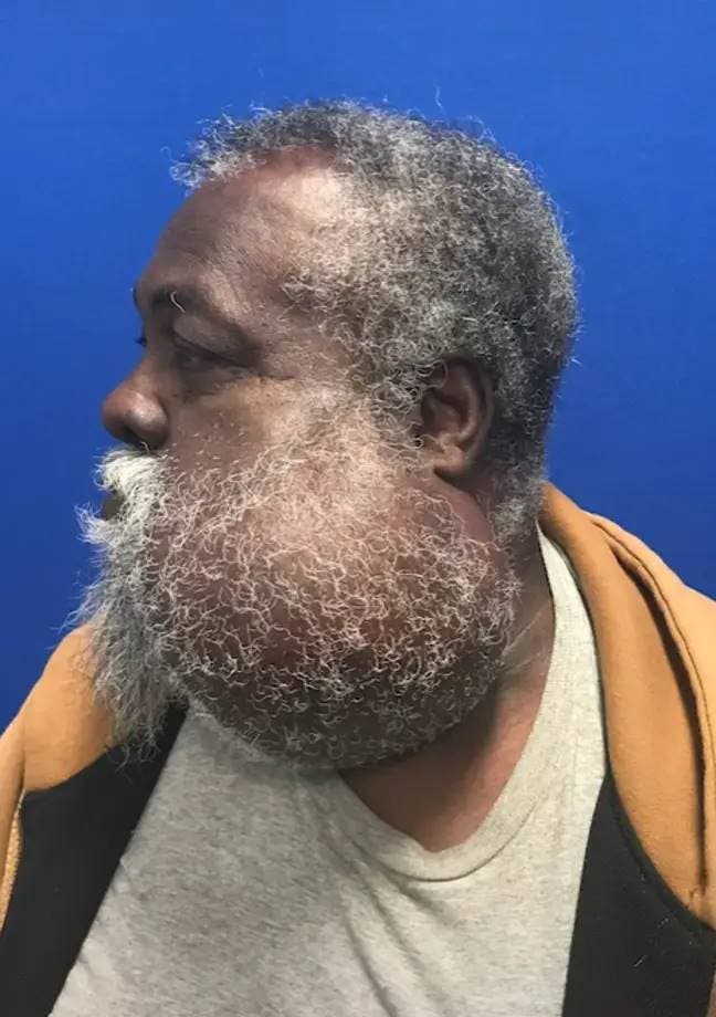 "Es divertido, lo haré gratis"–Quita el tumor facial más grande del ...